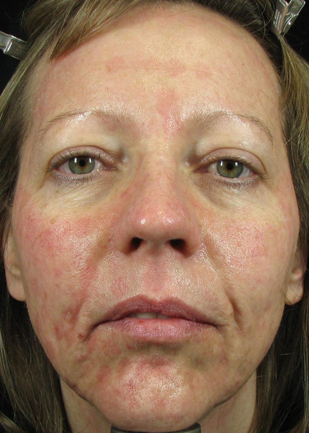 What To Expect After Pixel Laser Treatment At Doris Whitfield Blog