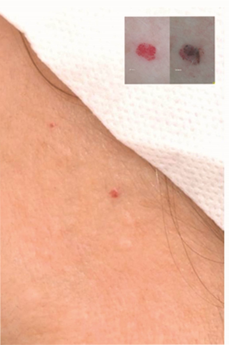 How to improve the appearance of your decolletage - Advanced ...